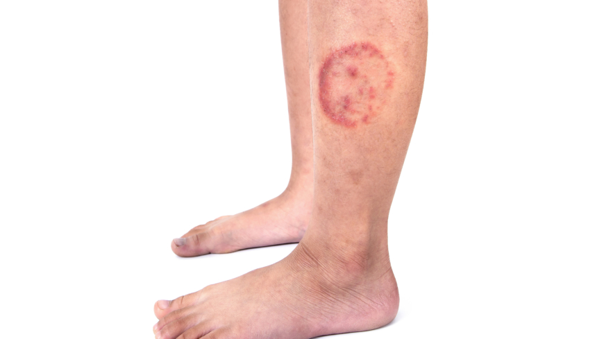 Ringorm – orsak, symtom, behandling | Doktorn.com