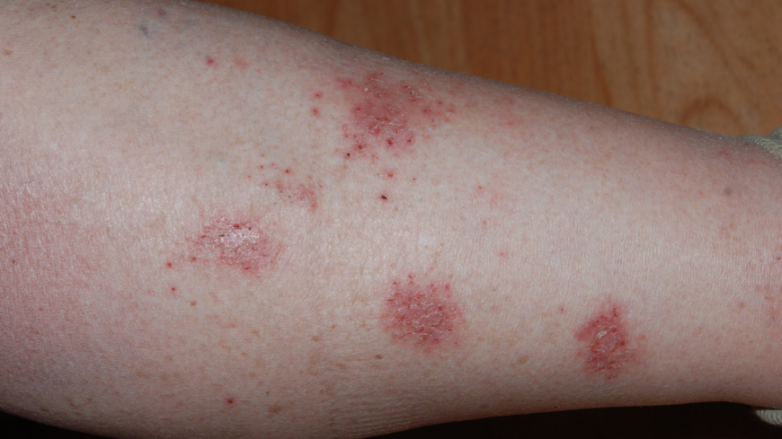 Eksem: orsak, symtom & behandling