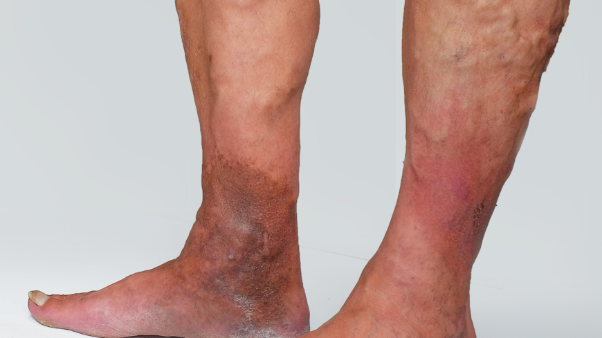 Eksem: orsak, symtom & behandling