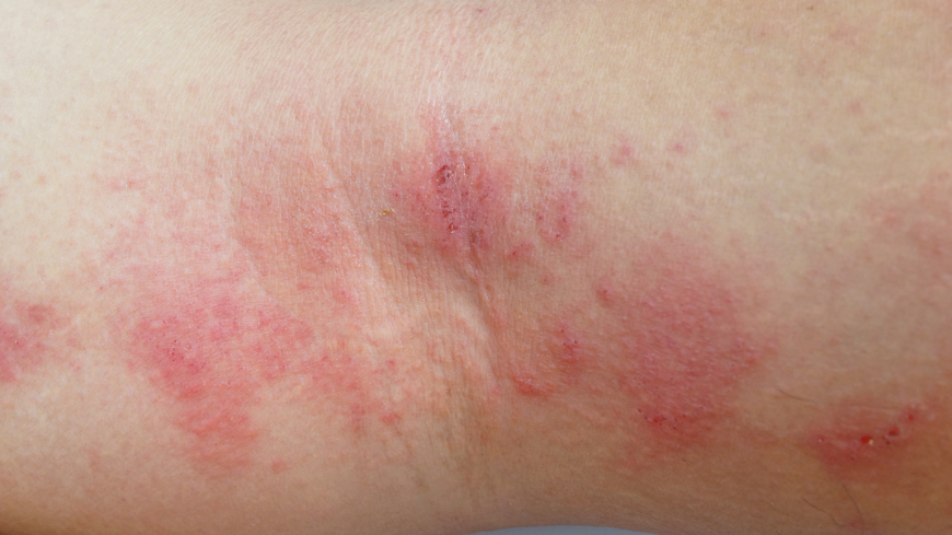 Eksem: orsak, symtom & behandling