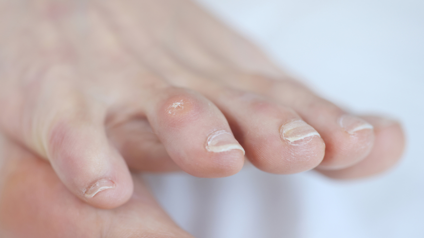 Förhårdnader, liktornar & självsprickor: orsak & behandling