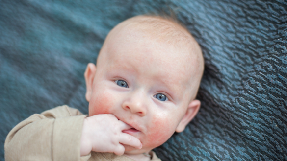 Allt om atopisk dermatit | Doktorn.com